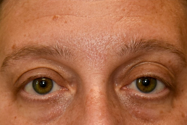 Gallery: Eyelid Surgery - Crystal Clinic Plastic Surgeons