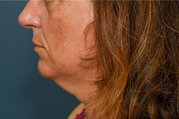 Gallery: Neck Lift - Crystal Clinic Plastic Surgeons
